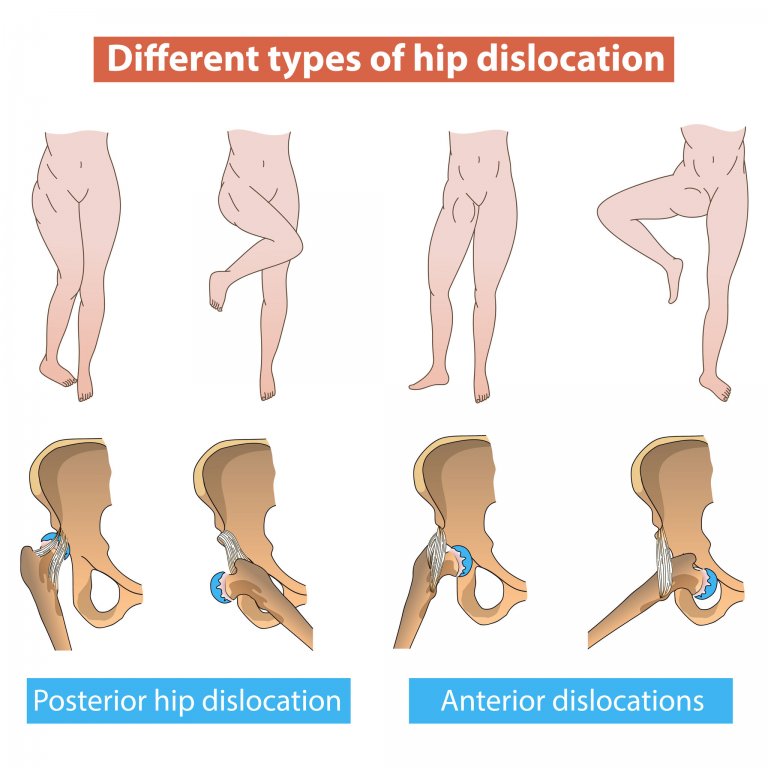 Dislocation Of Hip Joint