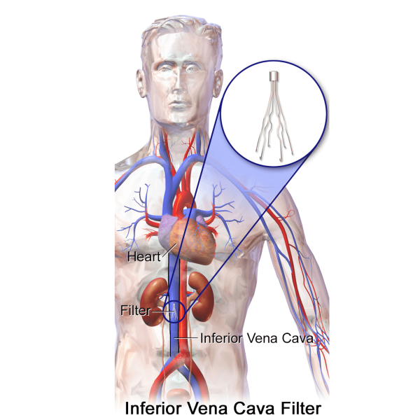 ¿Qué es la vena cava inferior?